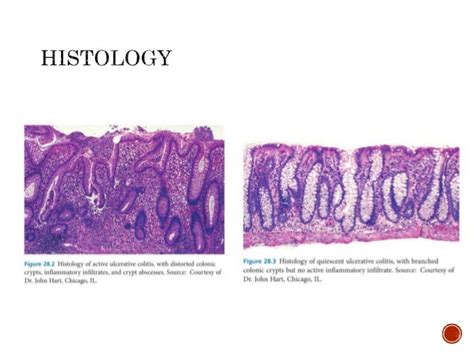 Ulcerative Colitis By Dr Ali Hasan