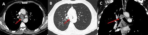 Lung Sarcomatoid Carcinoma An Intriguing Case Report Of A Rare
