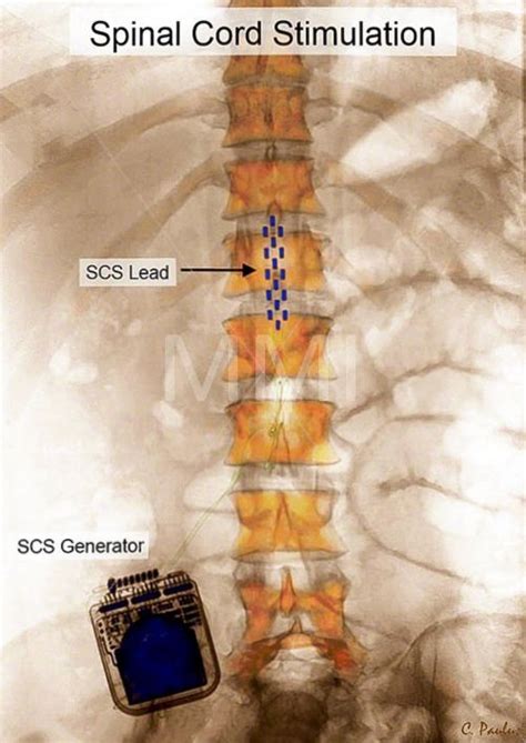 Boston Scientific Spinal Stimulator Reviews Tiktoktoktok