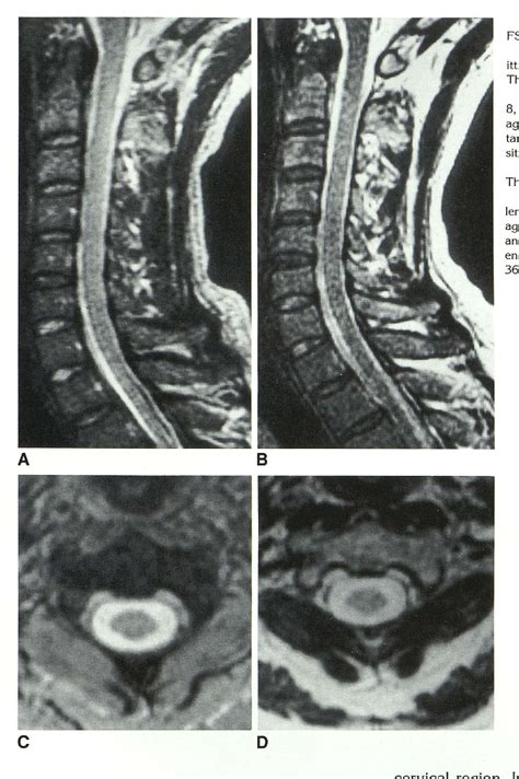 Figure 1 From Disease Of The Spine Fast Spin Echo Imaging In The
