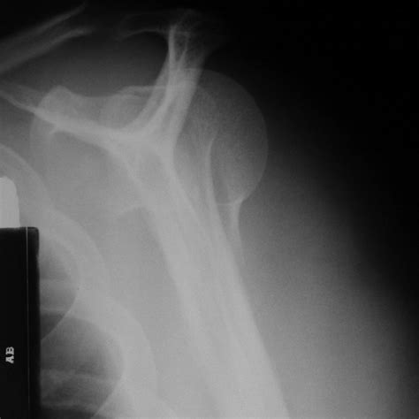 Radiograph Of The Left Shoulder On A Lateral View Download