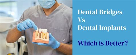 Dental Bridges Vs Dental Implants Which Is Better
