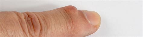 Mucous Cysts Oceanside Ortho