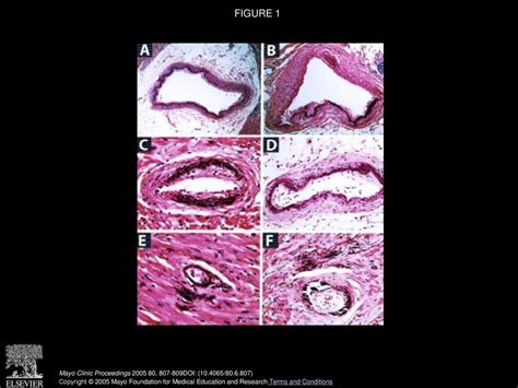 Jian Hua Qiao MD Terence M Doherty BA Michael C Ppt Download