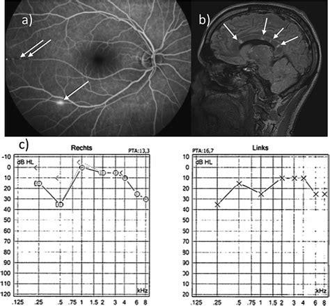 Atypical Clinical And Novel Radiological Findings In Susac Syndrome