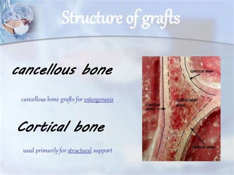 Application Of Bone Graft In Dentistry