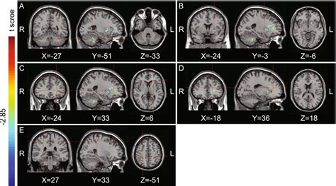 Regions Showing Significant Differences In Falff Between L Ch Patients