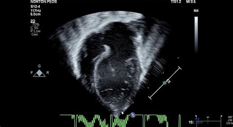Pediatric Heart Case Study Piccolo Device Closes PDA In Weeks Gestation Neonate Norton