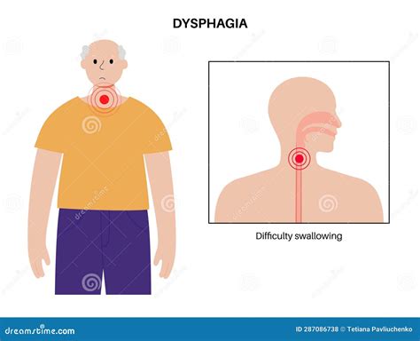 Esophageal Achalasia Disease Stock Illustration Illustration Of Pain
