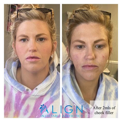 Mid Face Cheek Filler Artofit