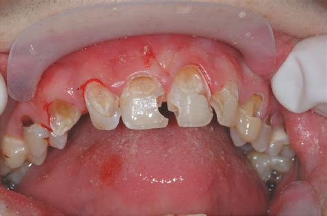 What Is High Caries Risk At Fawn Adams Blog