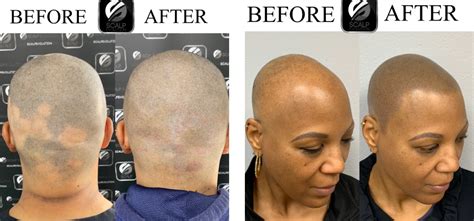 Scalp Micropigmentation For Scars Scalp Evolution Scalp Micropigmentation For Scars Scalp Evolution