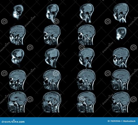 Imaging A Risonanza Magnetica Testa Di Mrt Di Rmi Fotografia Stock