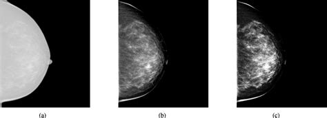 Figure 1 From Breast Cancer Detection Using Extreme Learning Machine