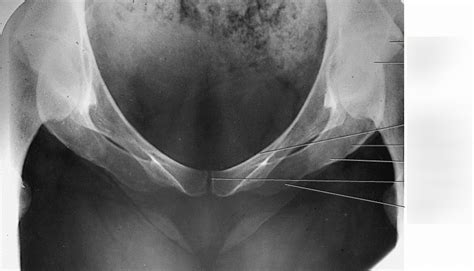 Xr Pelvis Inlet Lilienfeld Method Diagram Quizlet
