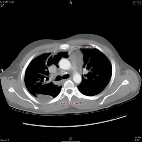 Axial Ct Chest Showing Pneumomediastinum Download Scientific Diagram
