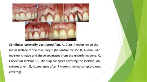 Root Coverage Procedures Periodonticspptx