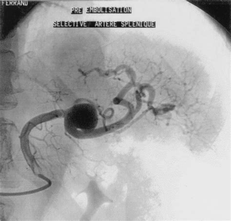Management Of Splenic Artery Aneurysms And False Aneurysms With