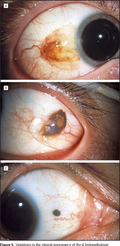 Conjunctival Nevus
