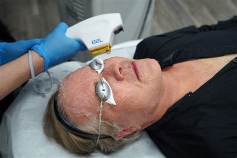 Bbl™ Broadband Light Vancouver Laser And Skin Care Centre
