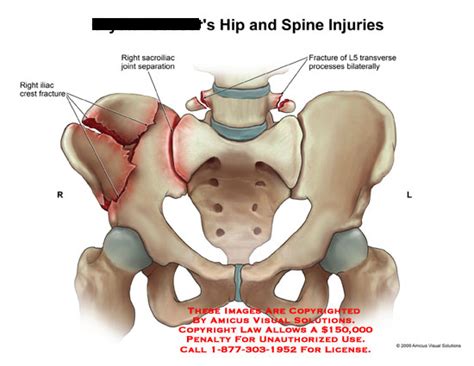 Hip And Spine Injuries
