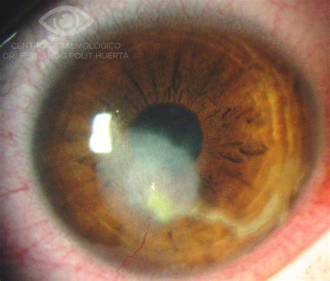 Queratitis Herpética Dendrítica Recurrente Con Leucoma Atlas De