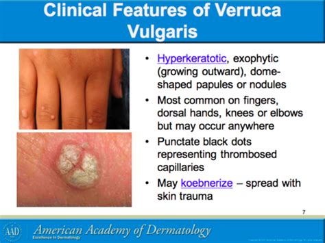 Warts And Molluscum Contagiosum Flashcards Quizlet