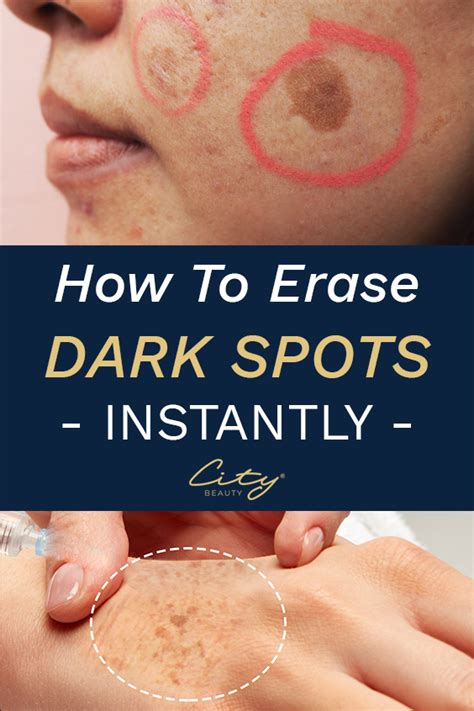 How To Fade Dark Spots Naturally How To Fade Spots On Face Dark