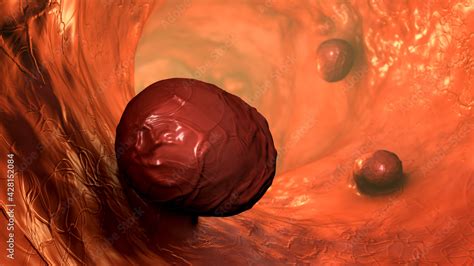 Bowel Polyps Colorectal Polyps 3d Illustration Stock Illustration