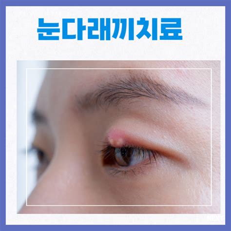눈다래끼 원인 치료 예방 다래끼 빨리 낫는법 네이버 블로그