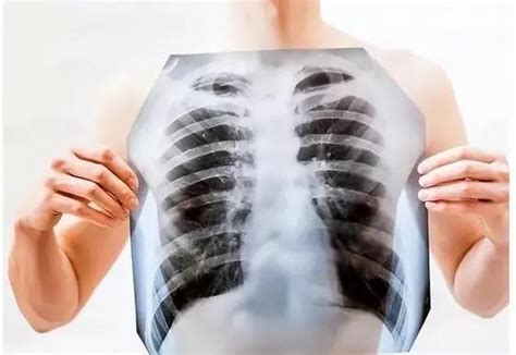 肺癌成为全球新增病例数最多癌症 知乎