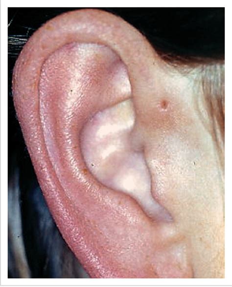 Congenital Malformations Of The Ear Ento Key