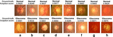 Examples Of Correct Normal And Glaucoma Classification Samples Of