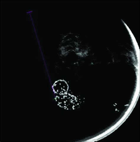 Image Guided Translumbar Type Ii Endoleak Repair A Novel Approach American Journal Of