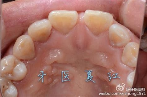 你不知道的前牙窩溝封閉術 每日頭條