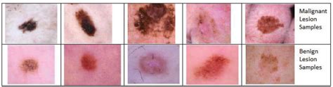 Figure 2 From Machine Learning Based Melanoma Skin Cancer Identification Using Feature Fusion Of