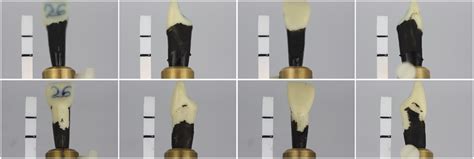Varnished Plastic Tooth Before And After Root Debridement The White