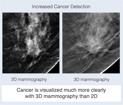 3d Screening Mammography Wake Radiology Unc Rex
