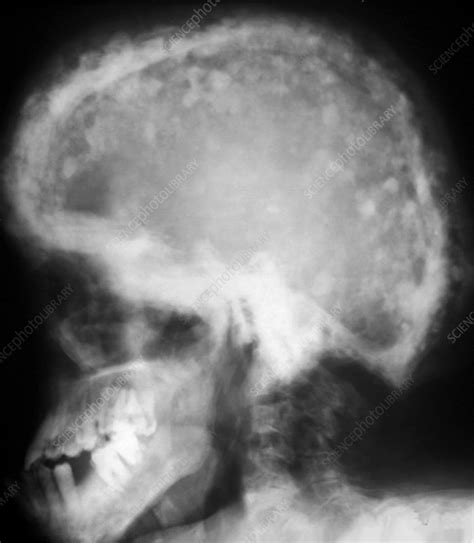 Pagets Disease Stock Image M2400488 Science Photo Library