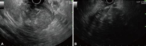 A Endoscopic Ultrasound Eus Imaging Showing Heterogeneous Echo