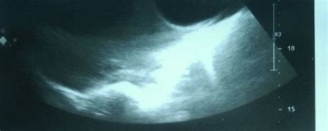 A Case Of Extrapulmonary Intrathoracic Hydatidosis With Pseudochylothorax Amini 2018