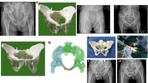 3d Printing In Orthopedics Ppt
