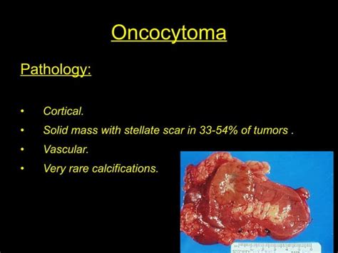 Oncocytoma PPT Medical Health