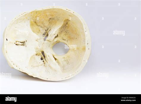 Foramen Magnum