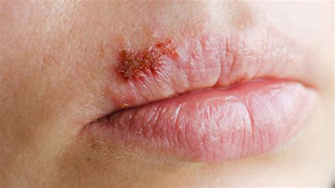 Are Your Lips Chapped Or Do You Have A Cold Sore Heres How To Tell