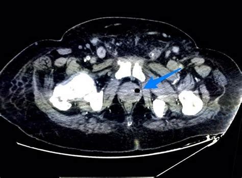 Ct Cross Sectional View Showing Air In The Prostate Gland Download Scientific Diagram