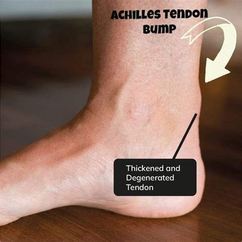 Runners Ankle Tendonitis At Paul Jamison Blog
