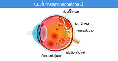 เบาหวานขึ้นตา เสี่ยงตาบอด จาก “จอประสาทตาลอก” Herbitia