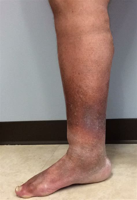 Peripheral Neuropathy Venous Insufficiency At Imogen Webb Blog