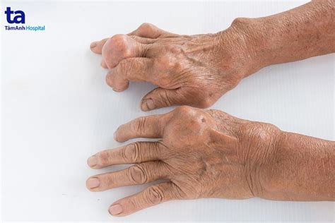 Hạt Tophi Nốt Tophi Nguyên Nhân Triệu Chứng Và điều Trị